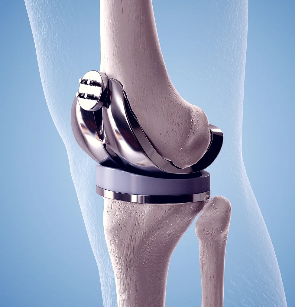 Robotic Assisted Surgery Knee Replacement Centurion Orthopaedic Centre Robotic Assisted Surgery Knee Replacement Centurion Orthopaedic Centre